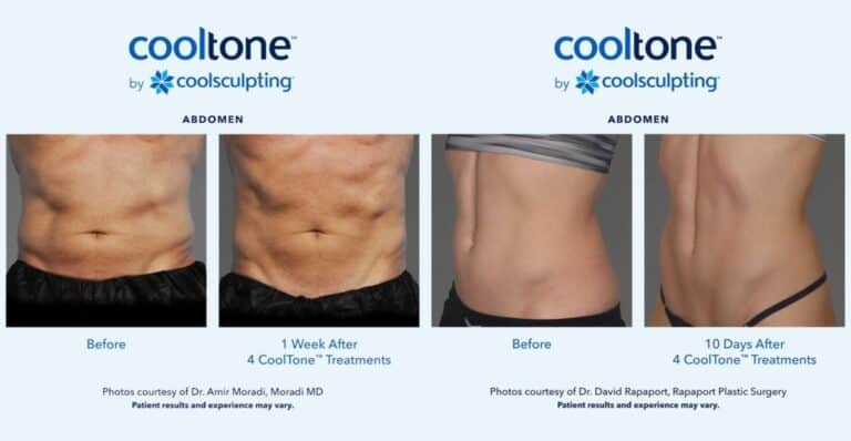 Cooltone in Scottsdale & Paradise Valley | Body Contouring