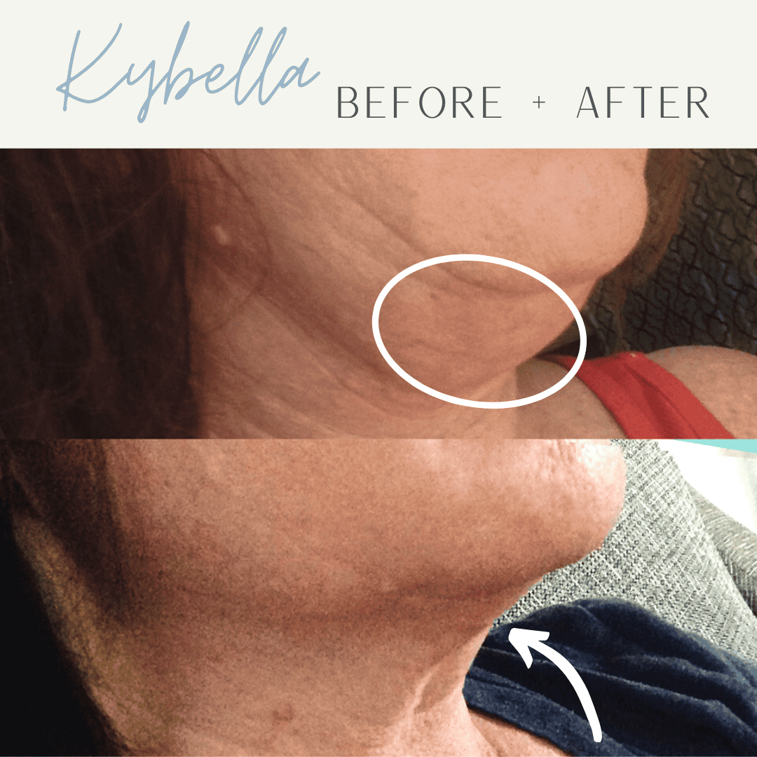 Buccal Fat Removal Vs Kybella at Alden Johnson blog